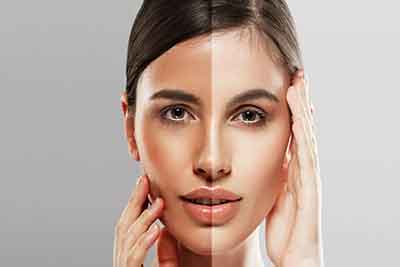 Skin Complexion Improvement - Dr. Rahul Dalal